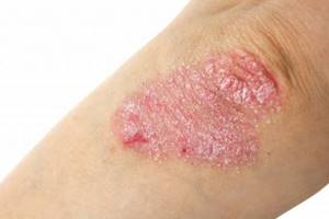 Dark and rough skin on the elbows - causes and remedies